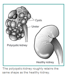 Polycystic Kidney Disease | UCSF Department of Surgery
